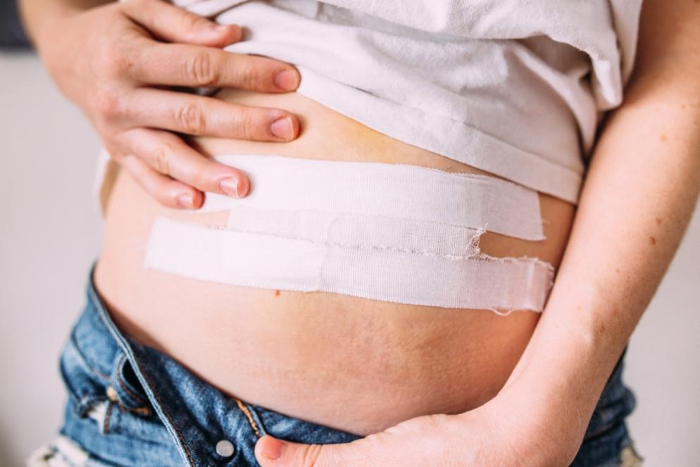 Hernia Umbilical Apos Gravidez