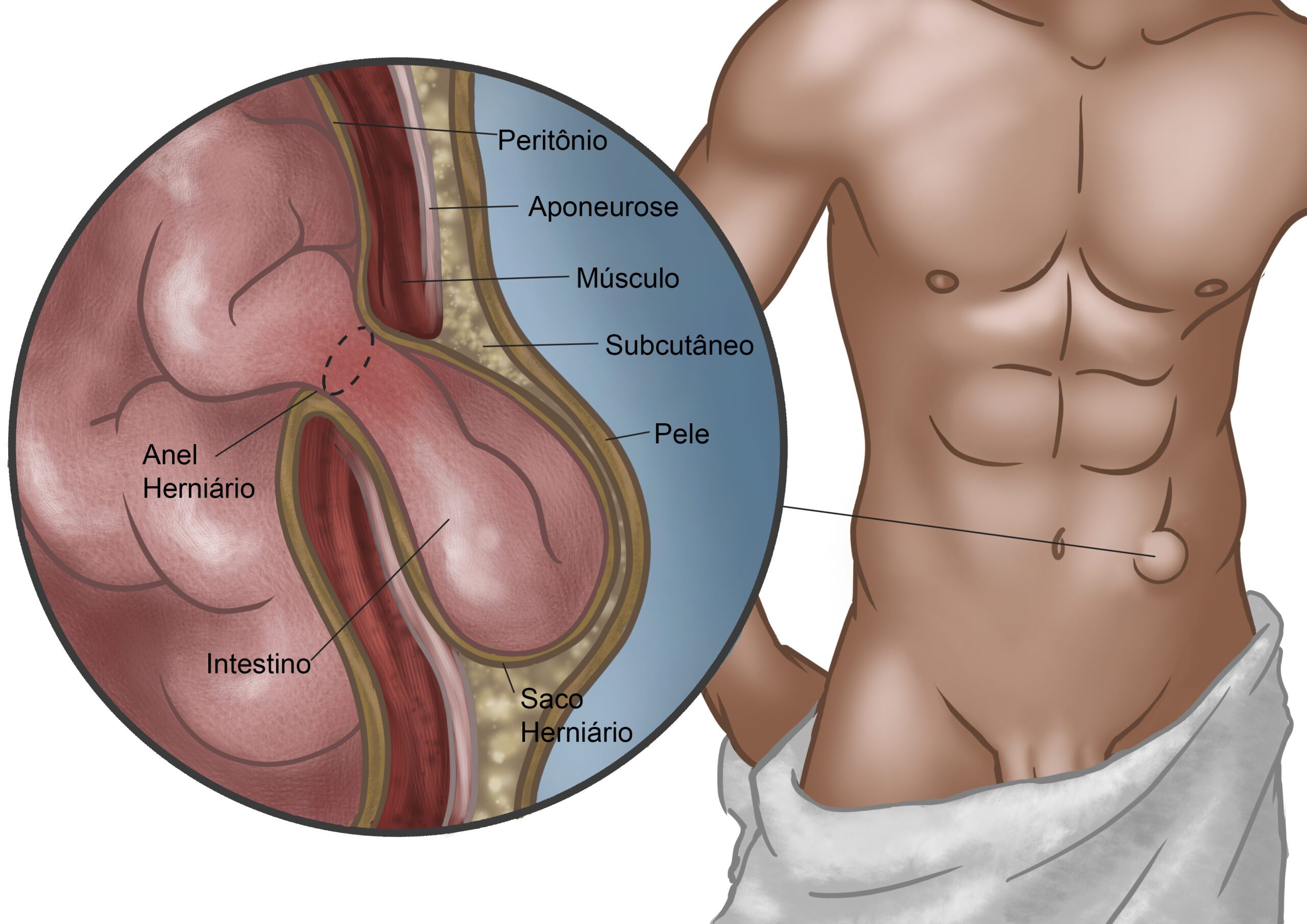 Anatomia Feminina De Hernia Inguinal Anatomia Feminina De Hernia Inguinal