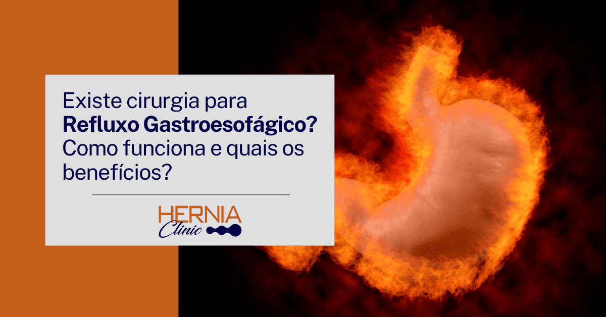 Existe cirurgia para Refluxo Gastroesofágico? Como funciona e quais os ...